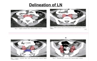 PELVIC LYMPH NODES TARGET DELINEATION Dr Syed Aman.pptx