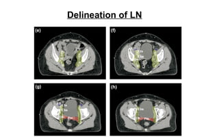 PELVIC LYMPH NODES TARGET DELINEATION Dr Syed Aman.pptx
