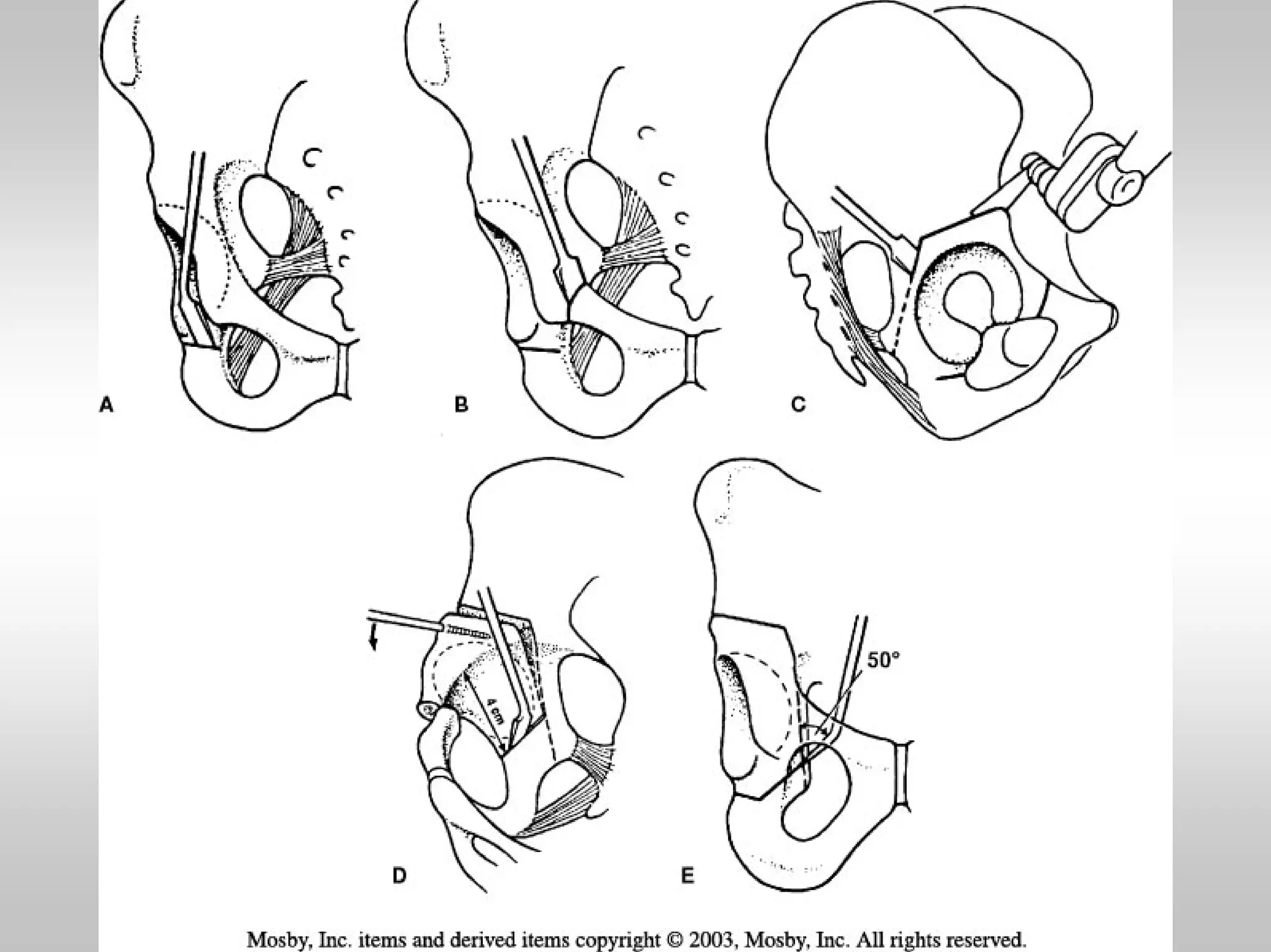 Pelvic osteotomies | PDF