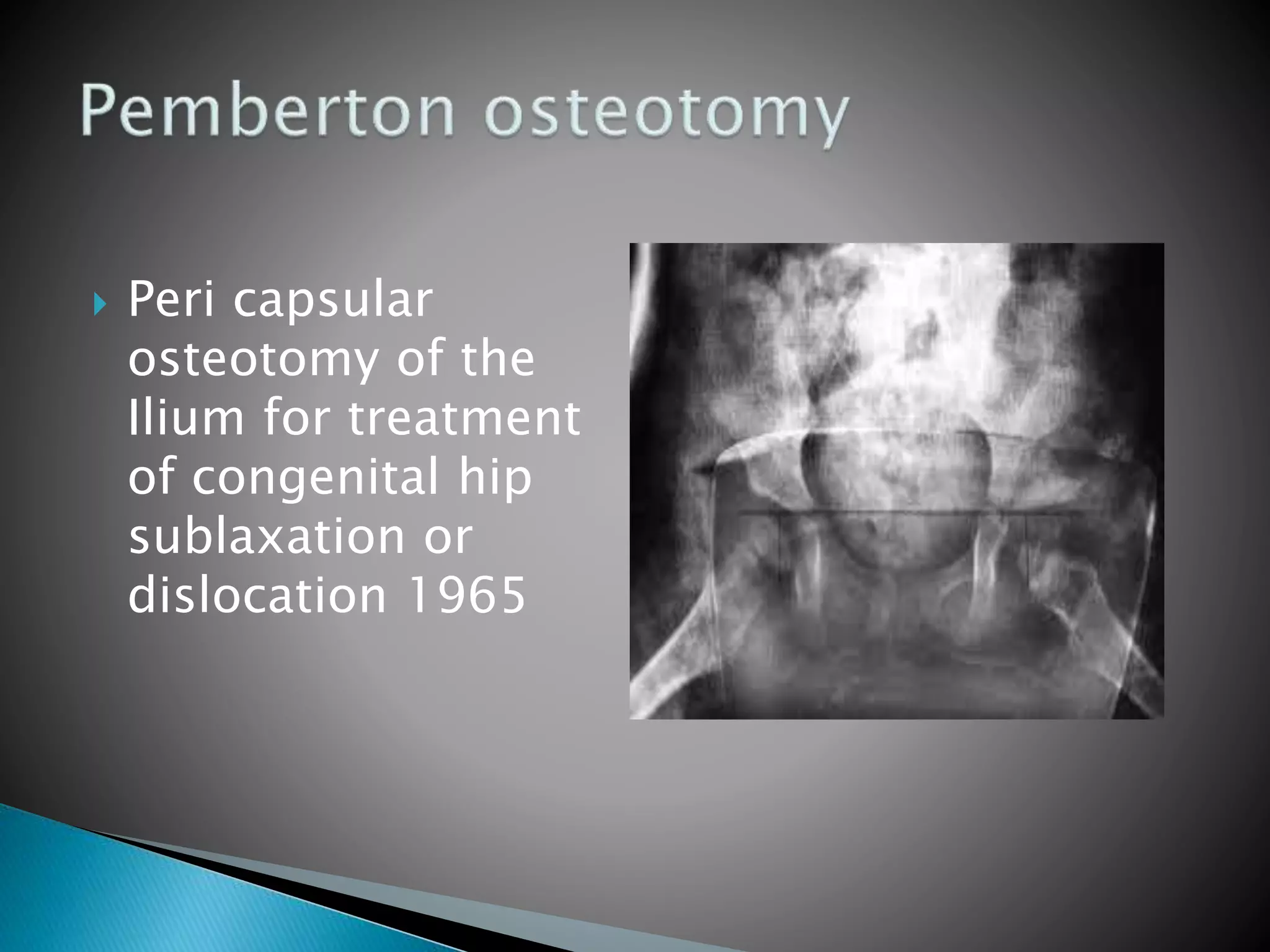 Pelvic osteotomy in pediatric | PPTX