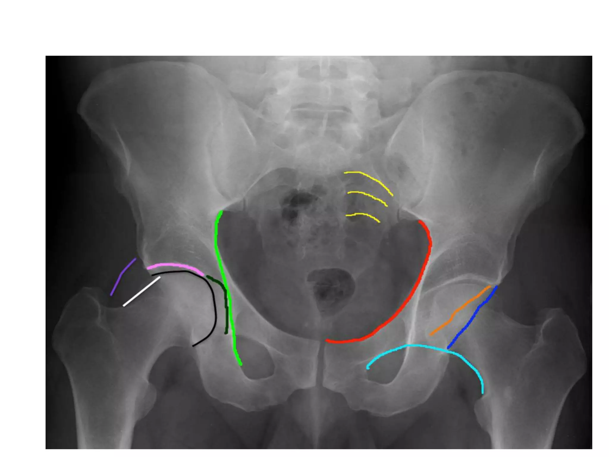 Pelvic radiographs | PPTX