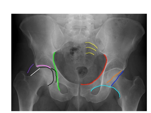 Pelvic radiographs | PPTX