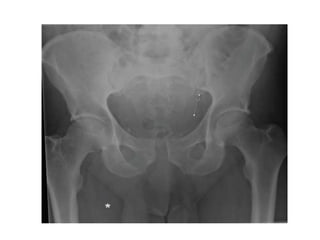 Pelvic radiographs | PPTX