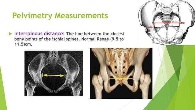 Pelvimetry | PPTX