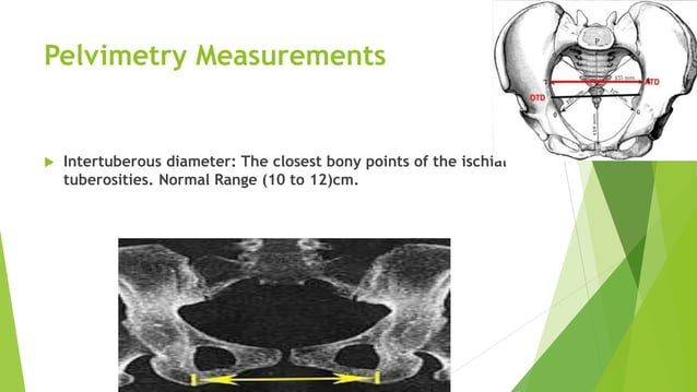 Pelvimetry | PPTX