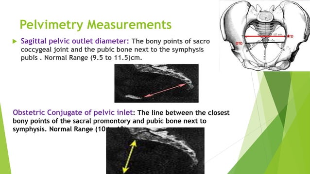Pelvimetry | PPTX