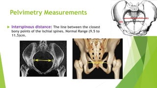 Pelvimetry | PPT