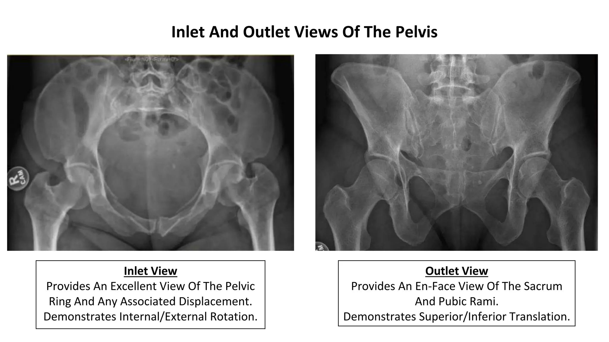 Adult Orthopedic Imaging Mastery Project - Pelvic Ring Fractures | PPTX