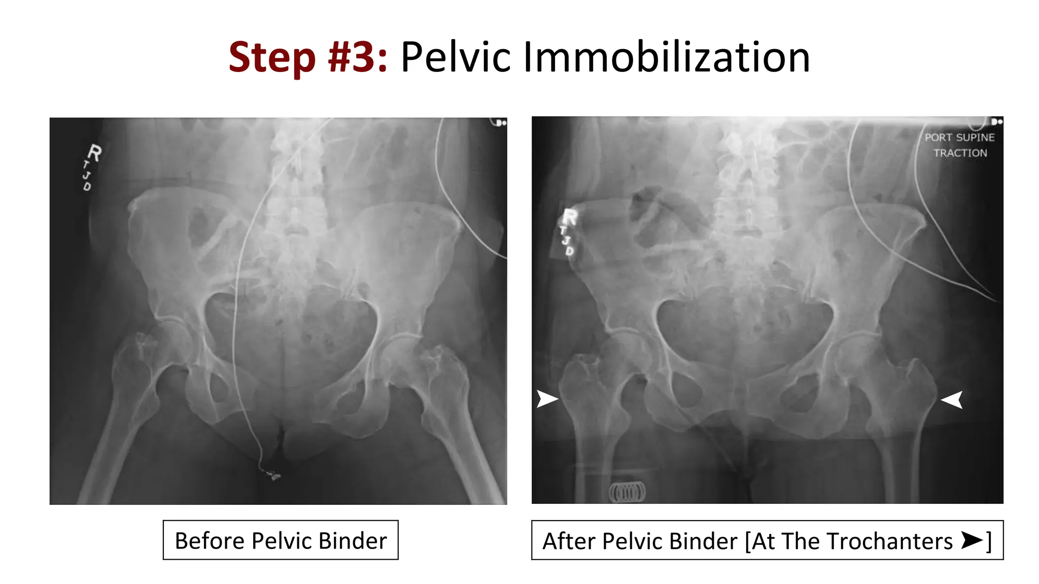 Adult Orthopedic Imaging Mastery Project - Pelvic Ring Fractures | PPTX