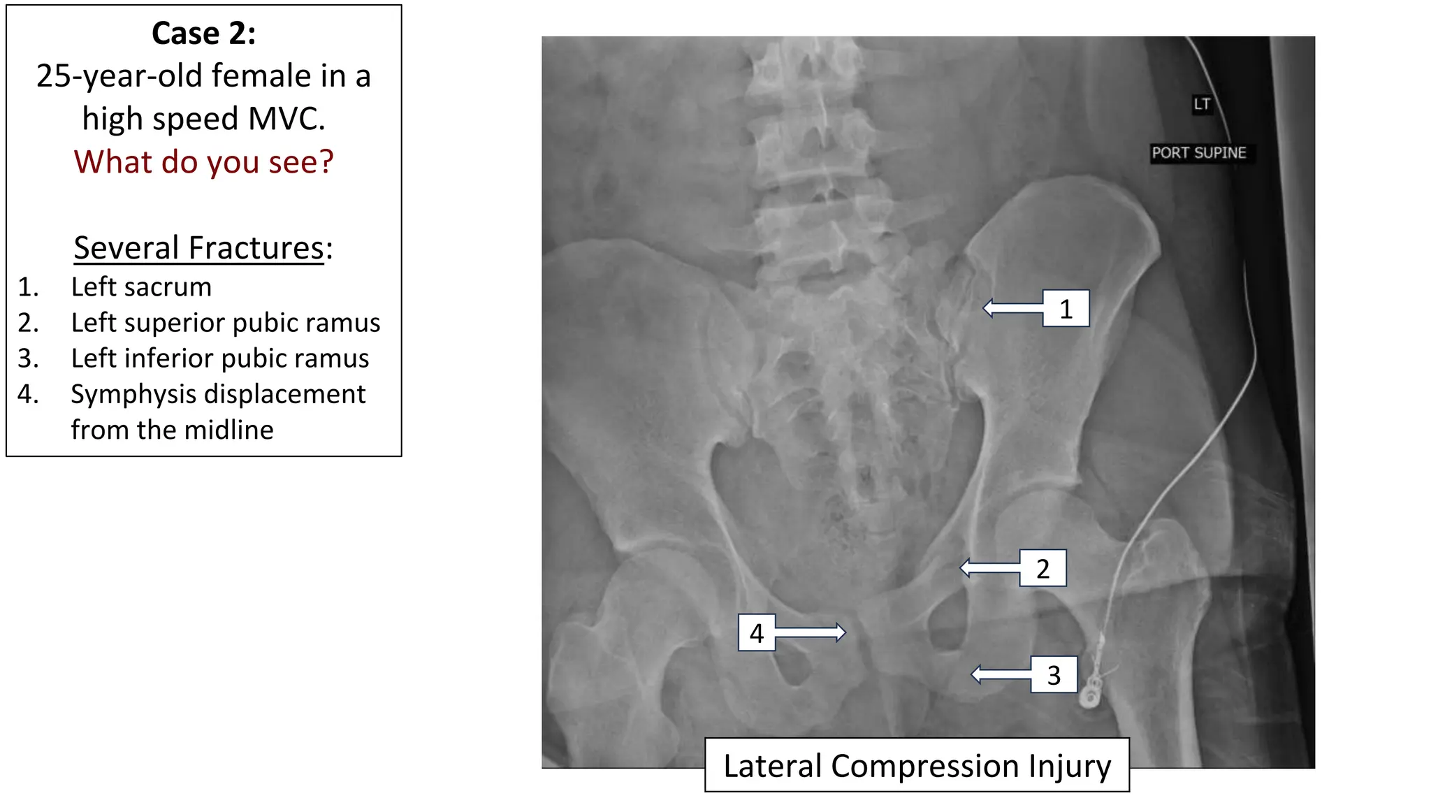 Adult Orthopedic Imaging Mastery Project - Pelvic Ring Fractures | PPTX