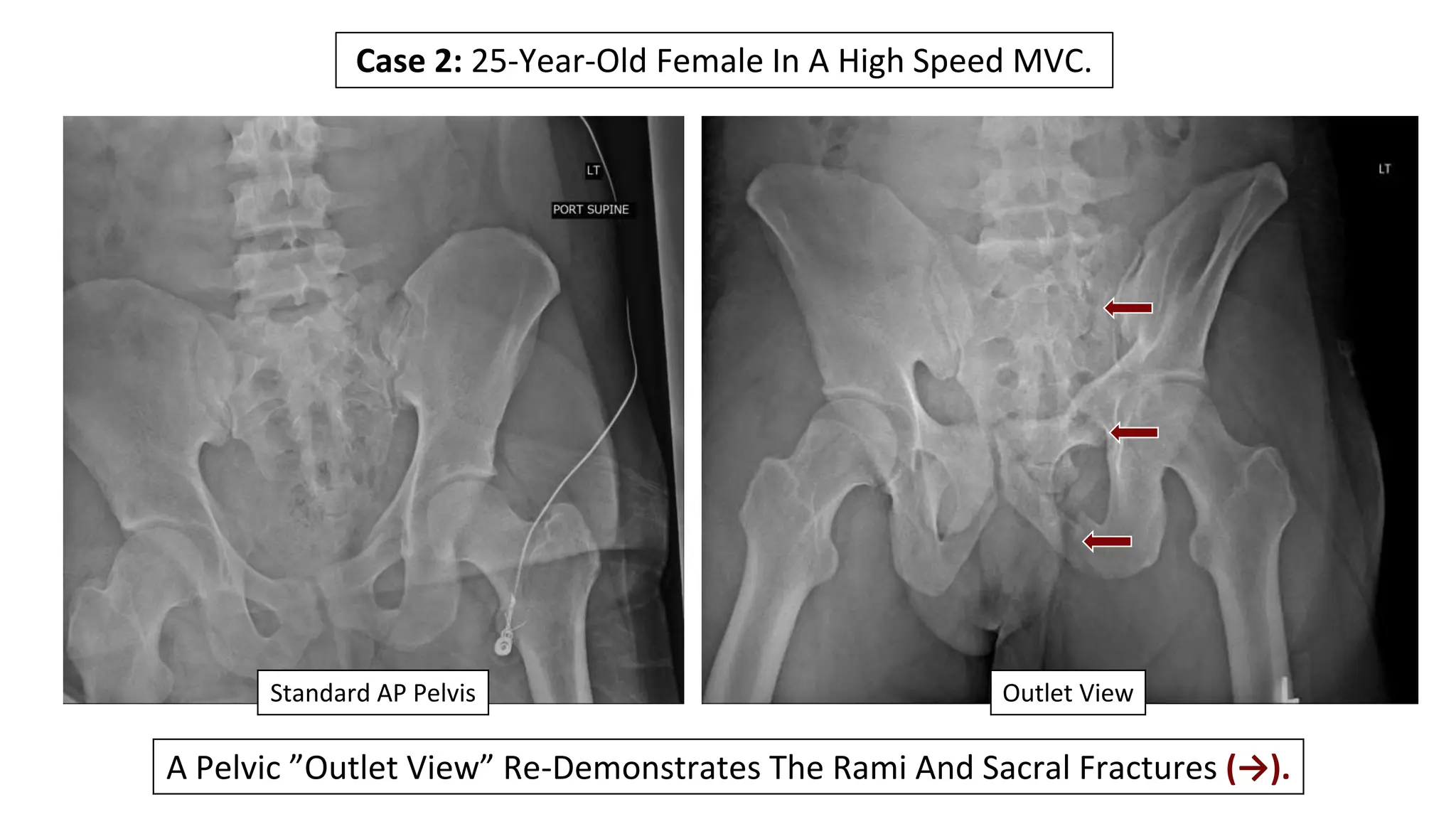 Adult Orthopedic Imaging Mastery Project - Pelvic Ring Fractures | PPTX