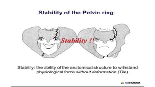 Pelvic ring fractures | PPTX