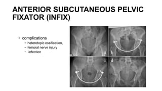 Pelvic ring fractures | PPTX