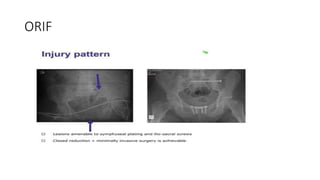 Pelvic ring fractures | PPTX