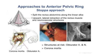 Pelvic ring fractures | PPTX