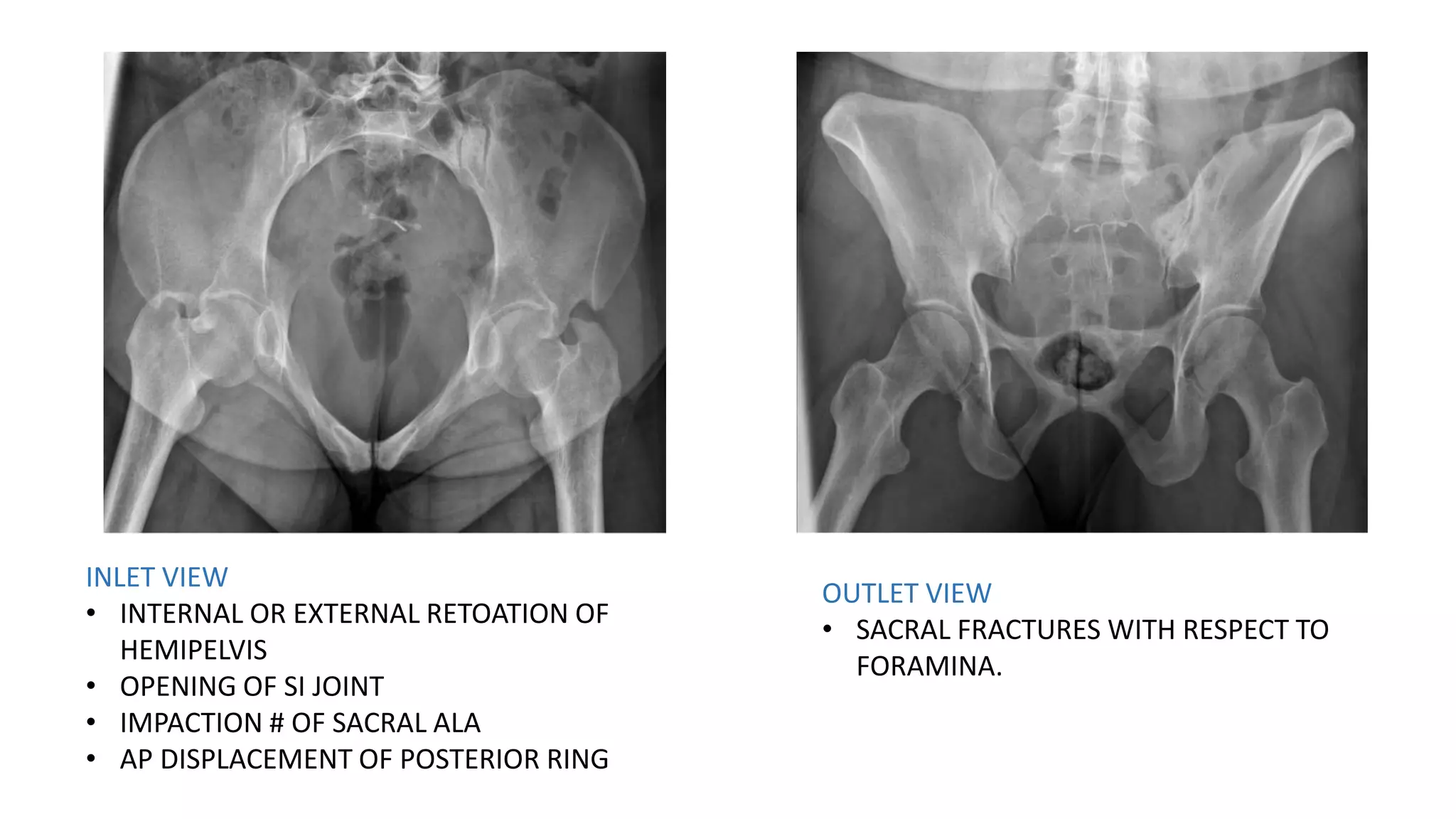 PELVIC RING FRACTURES | PPTX