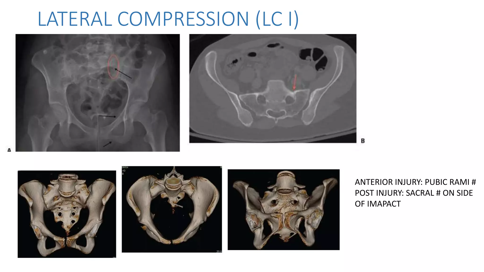 PELVIC RING FRACTURES | PPTX