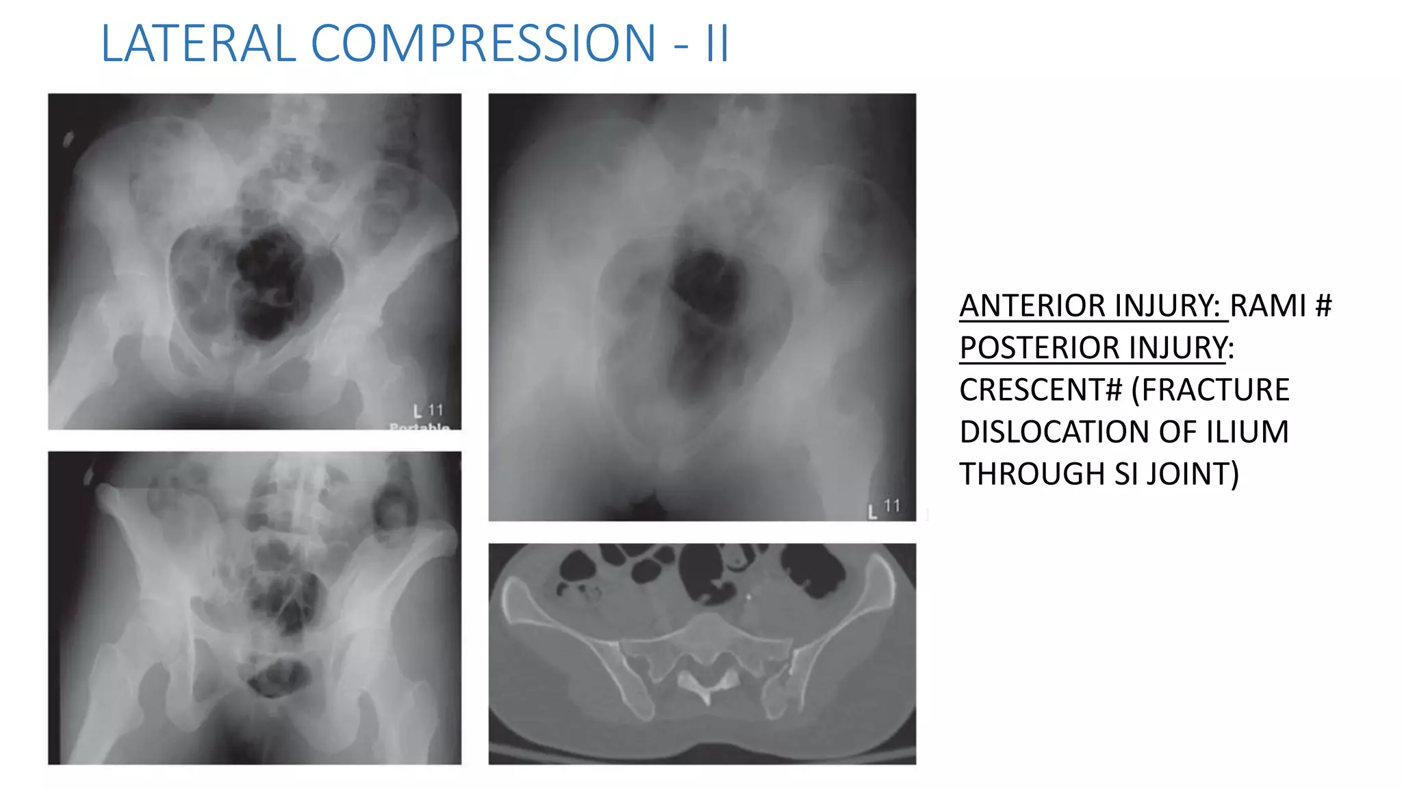 PELVIC RING FRACTURES | PPTX