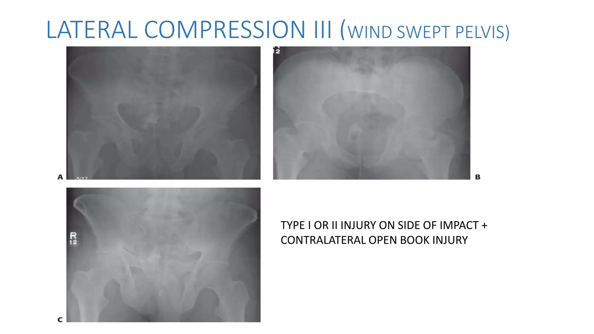 PELVIC RING FRACTURES | PPTX