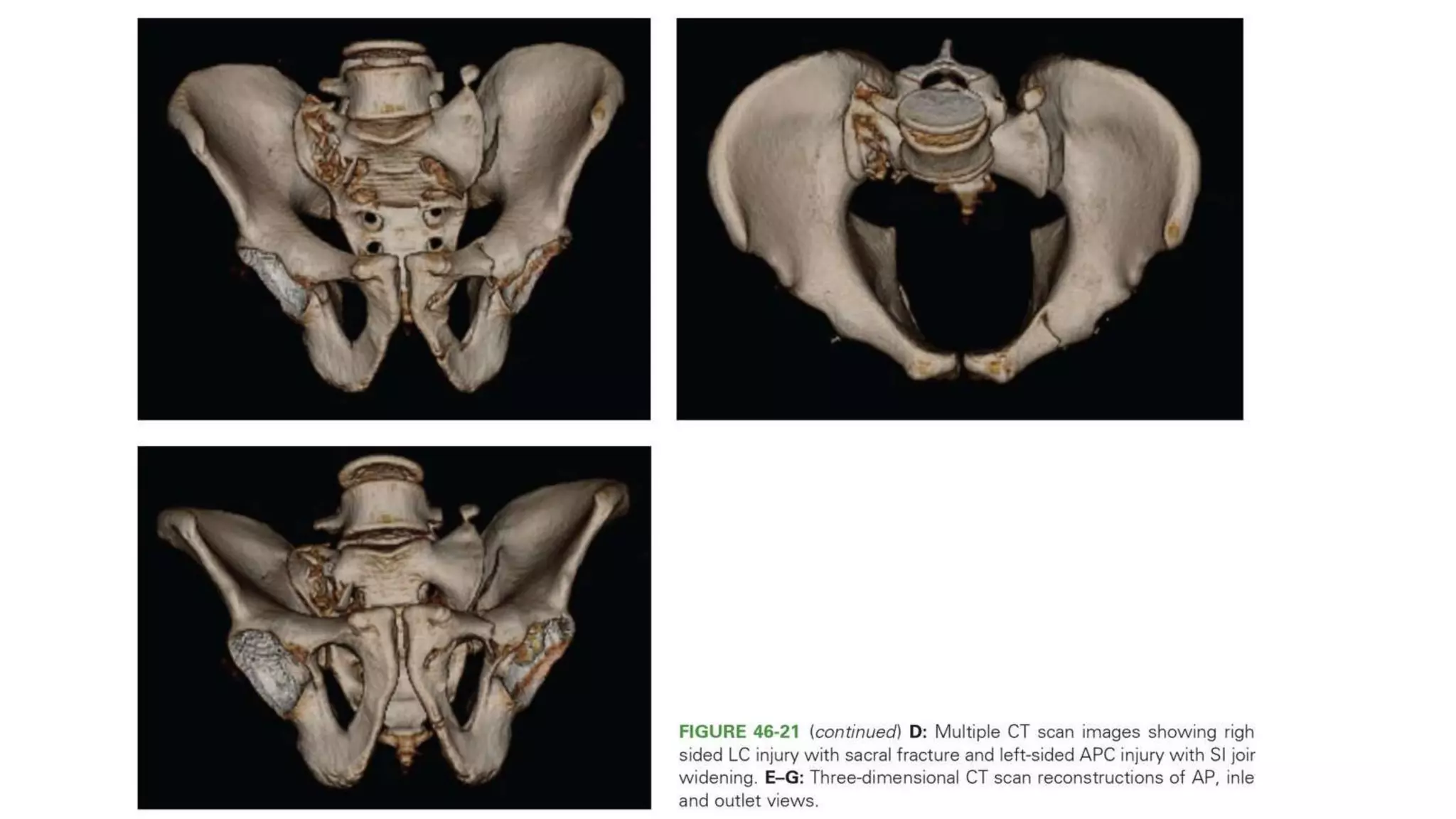 PELVIC RING FRACTURES | PPTX