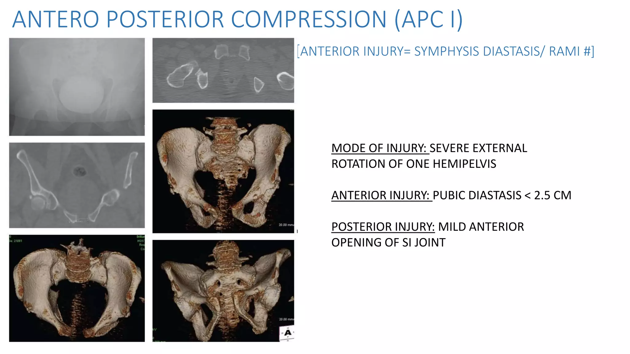 PELVIC RING FRACTURES | PPTX