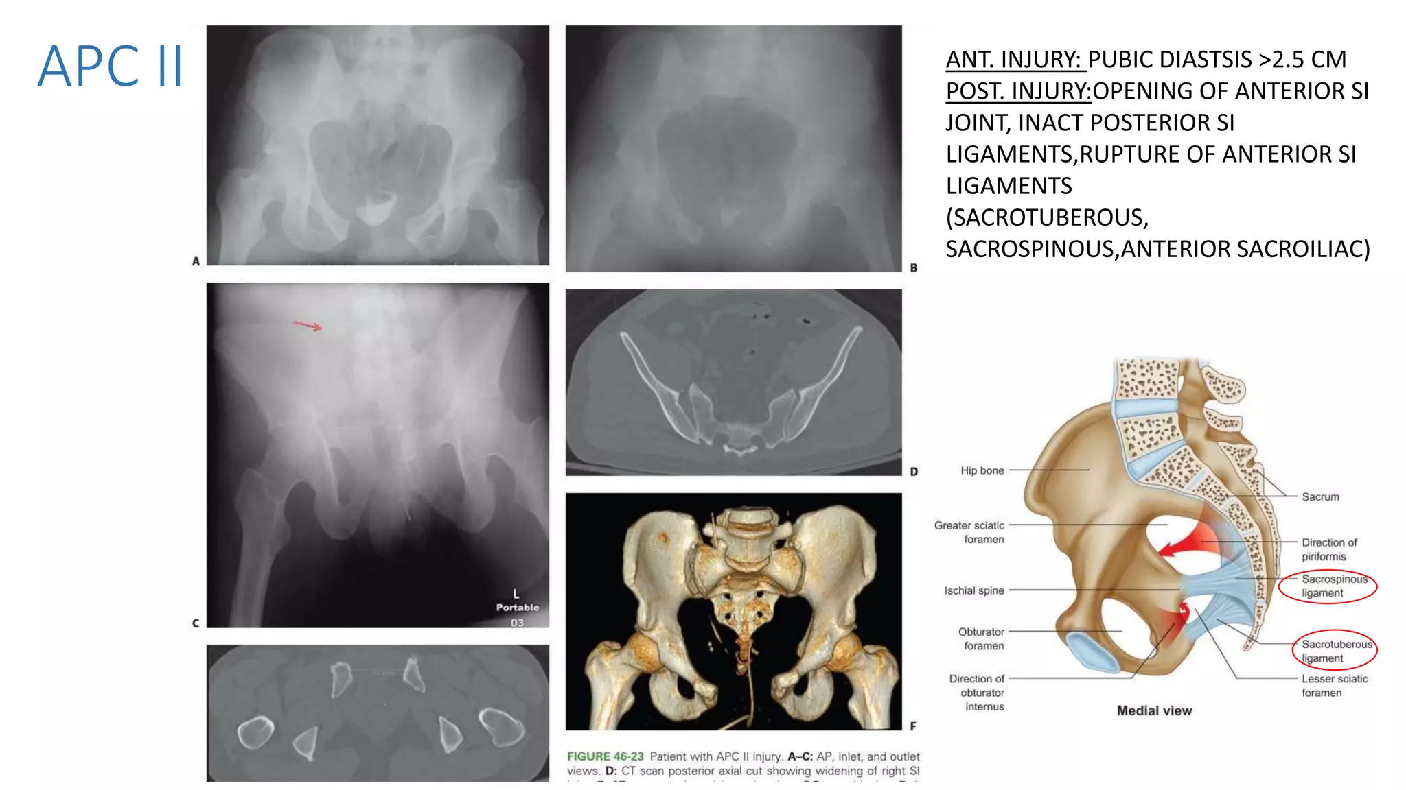 PELVIC RING FRACTURES | PPTX
