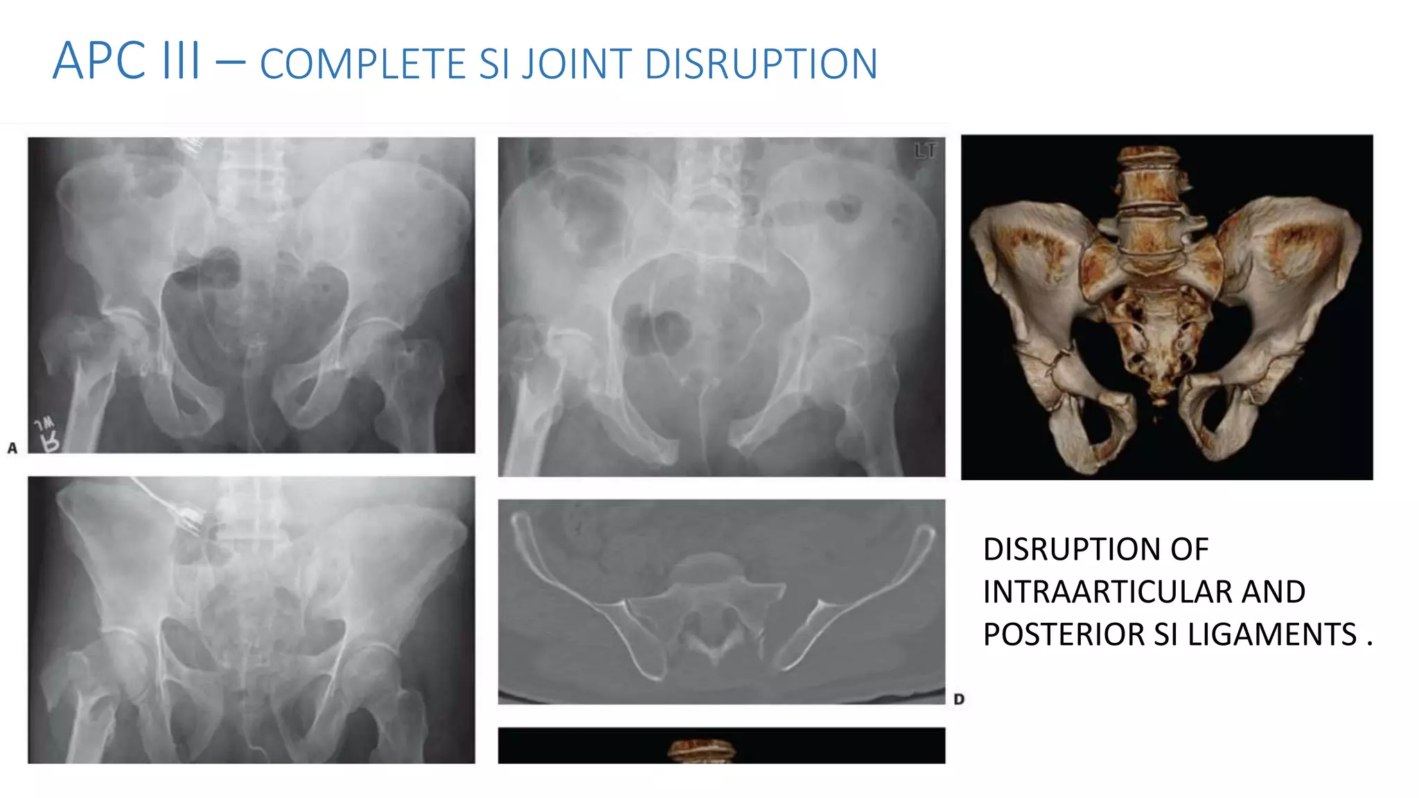 PELVIC RING FRACTURES | PPTX