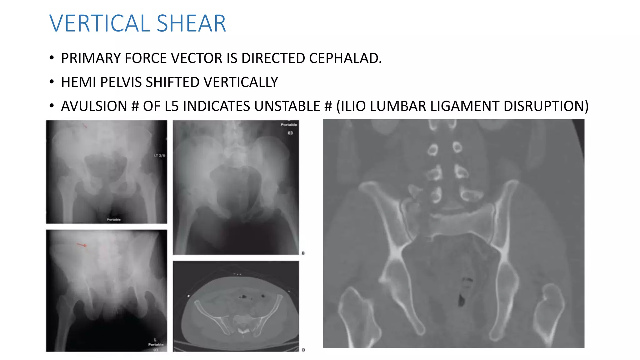 PELVIC RING FRACTURES | PPTX