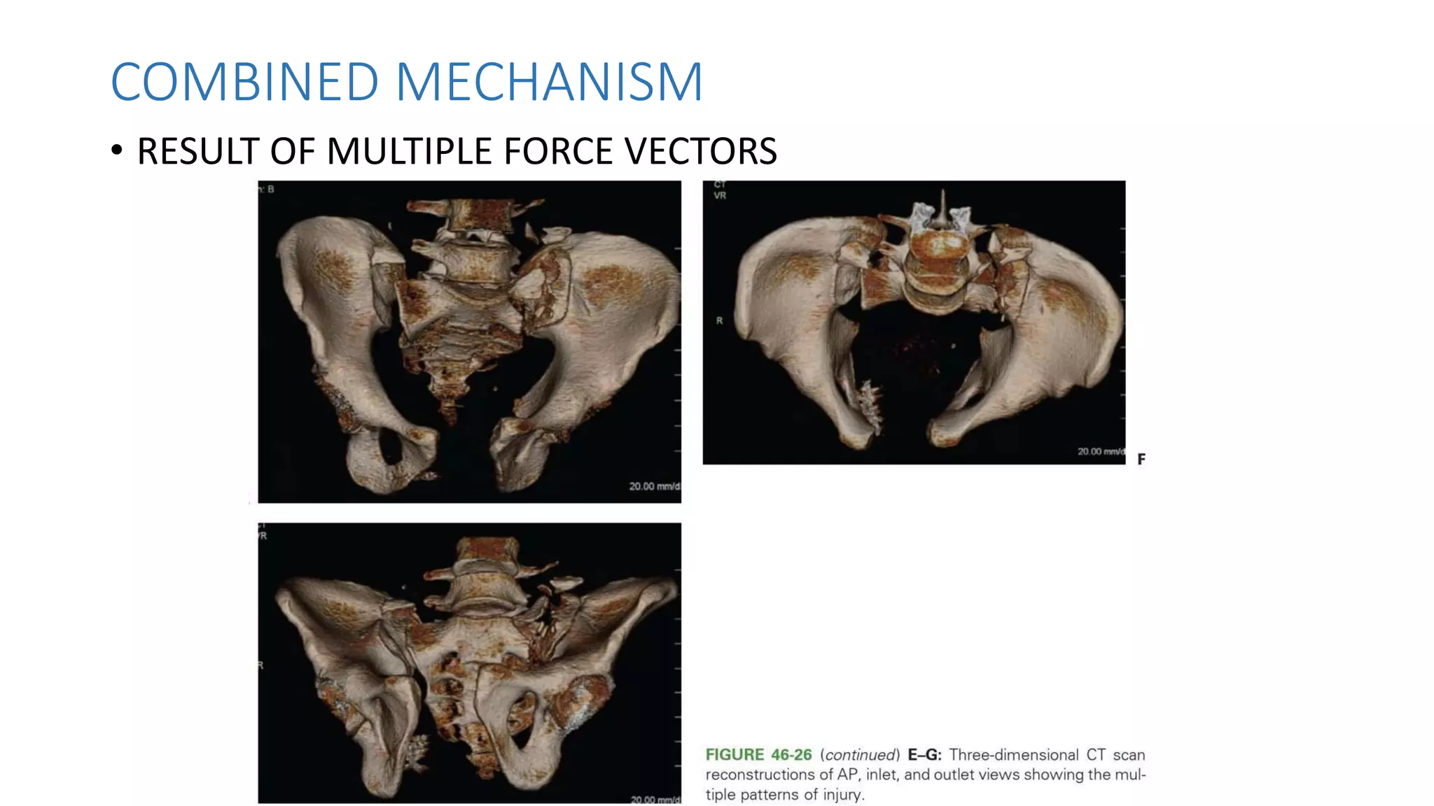 PELVIC RING FRACTURES | PPTX