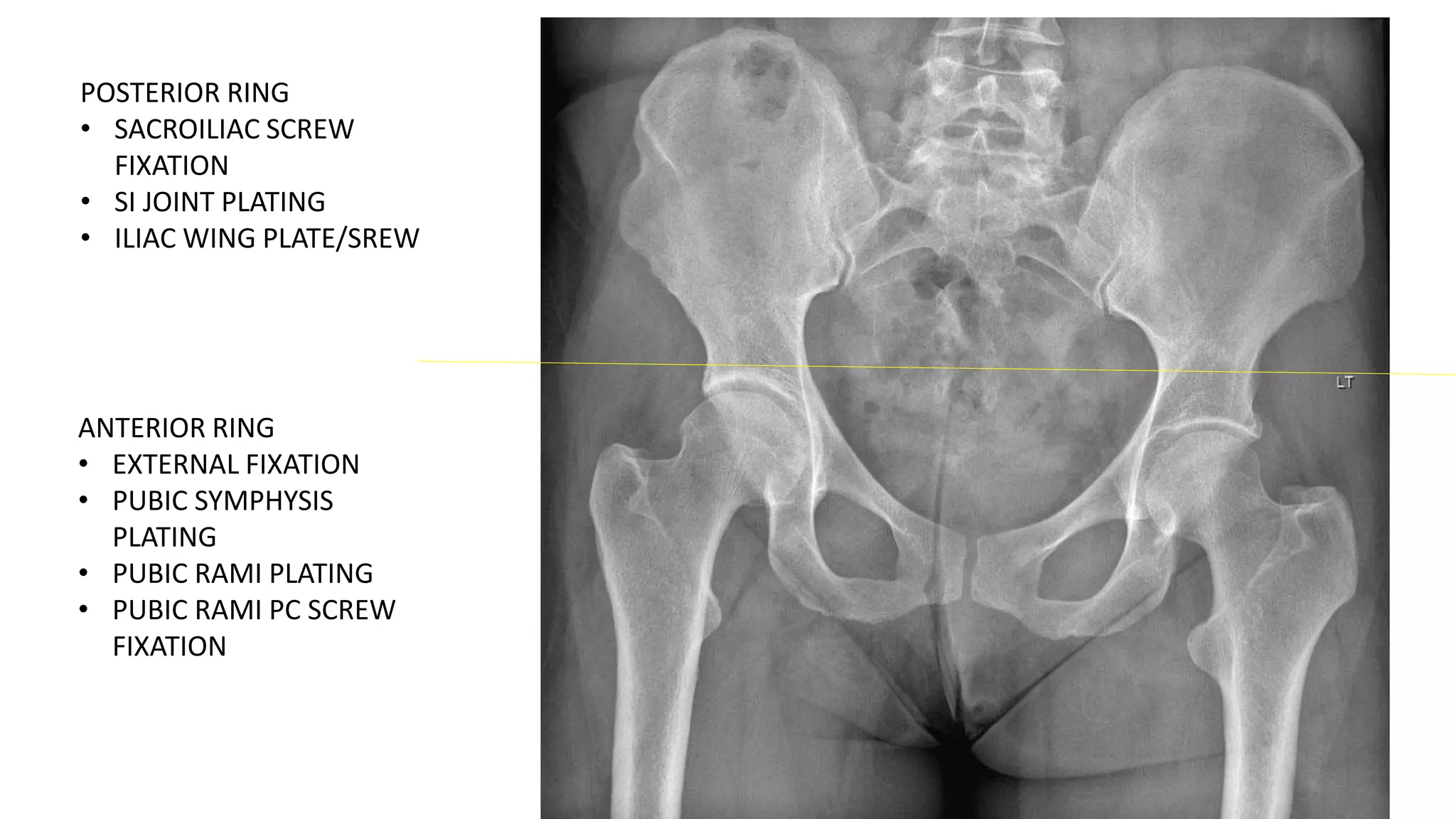 PELVIC RING FRACTURES | PPTX
