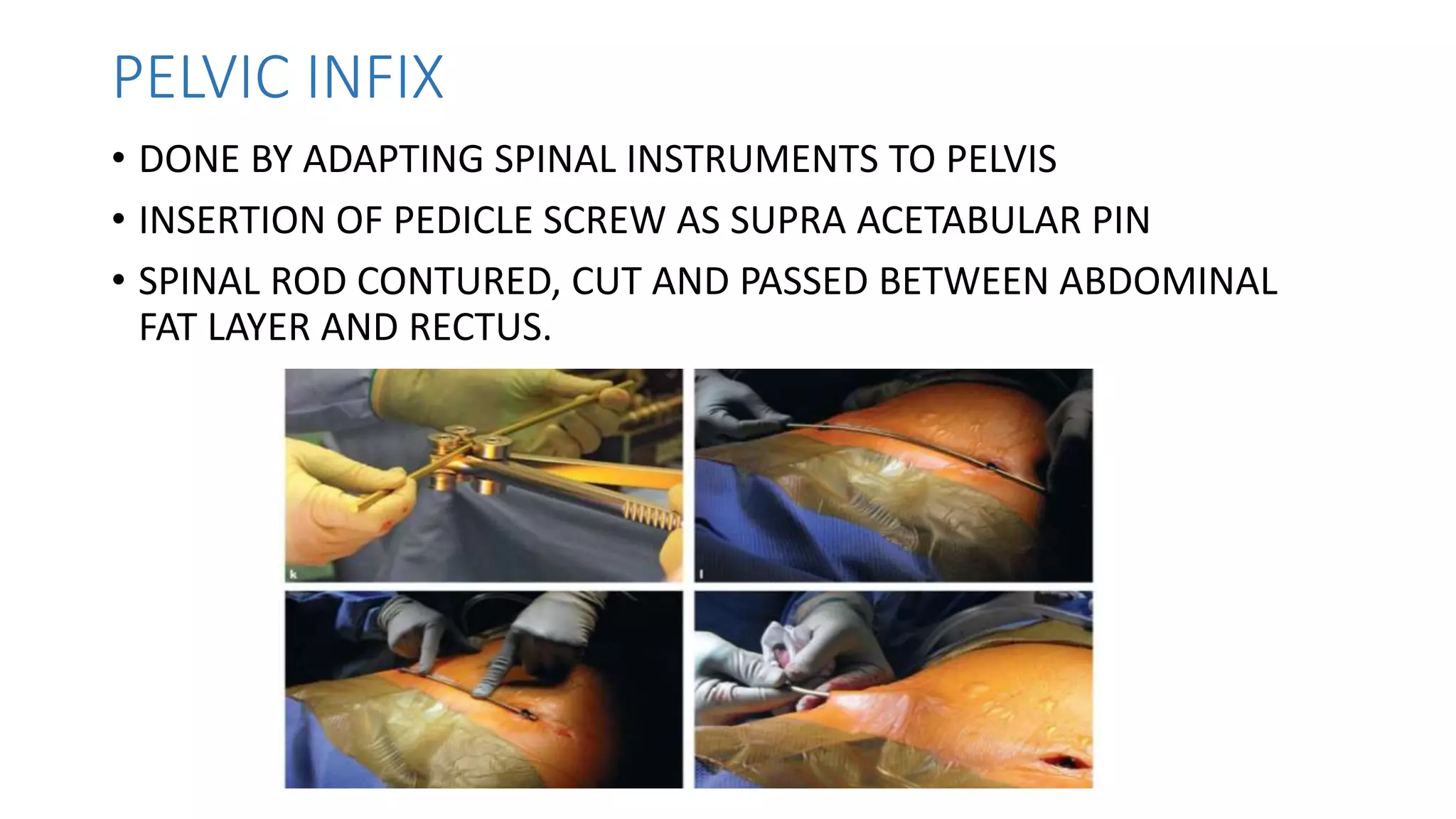 PELVIC RING FRACTURES | PPTX
