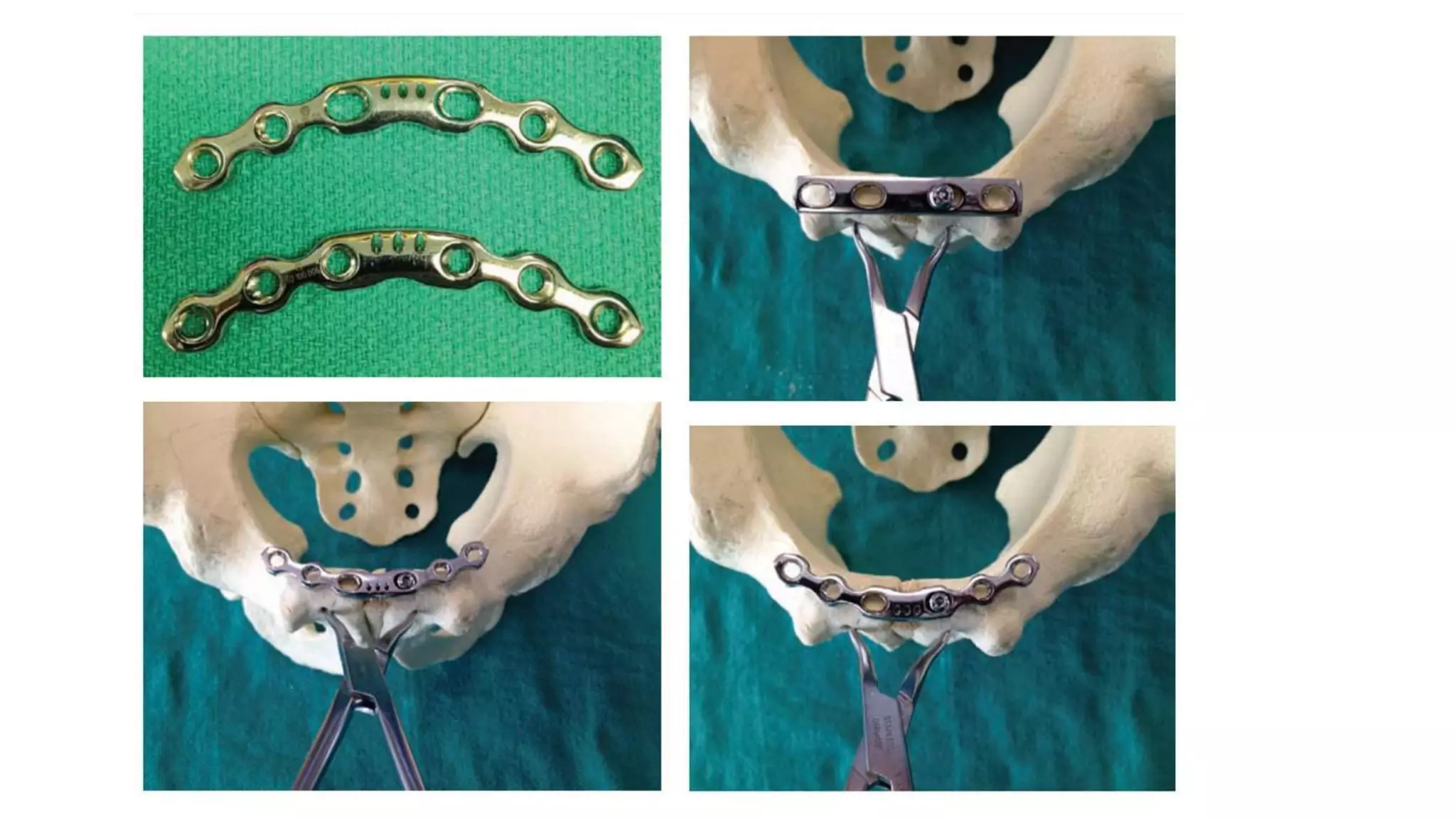 PELVIC RING FRACTURES | PPTX