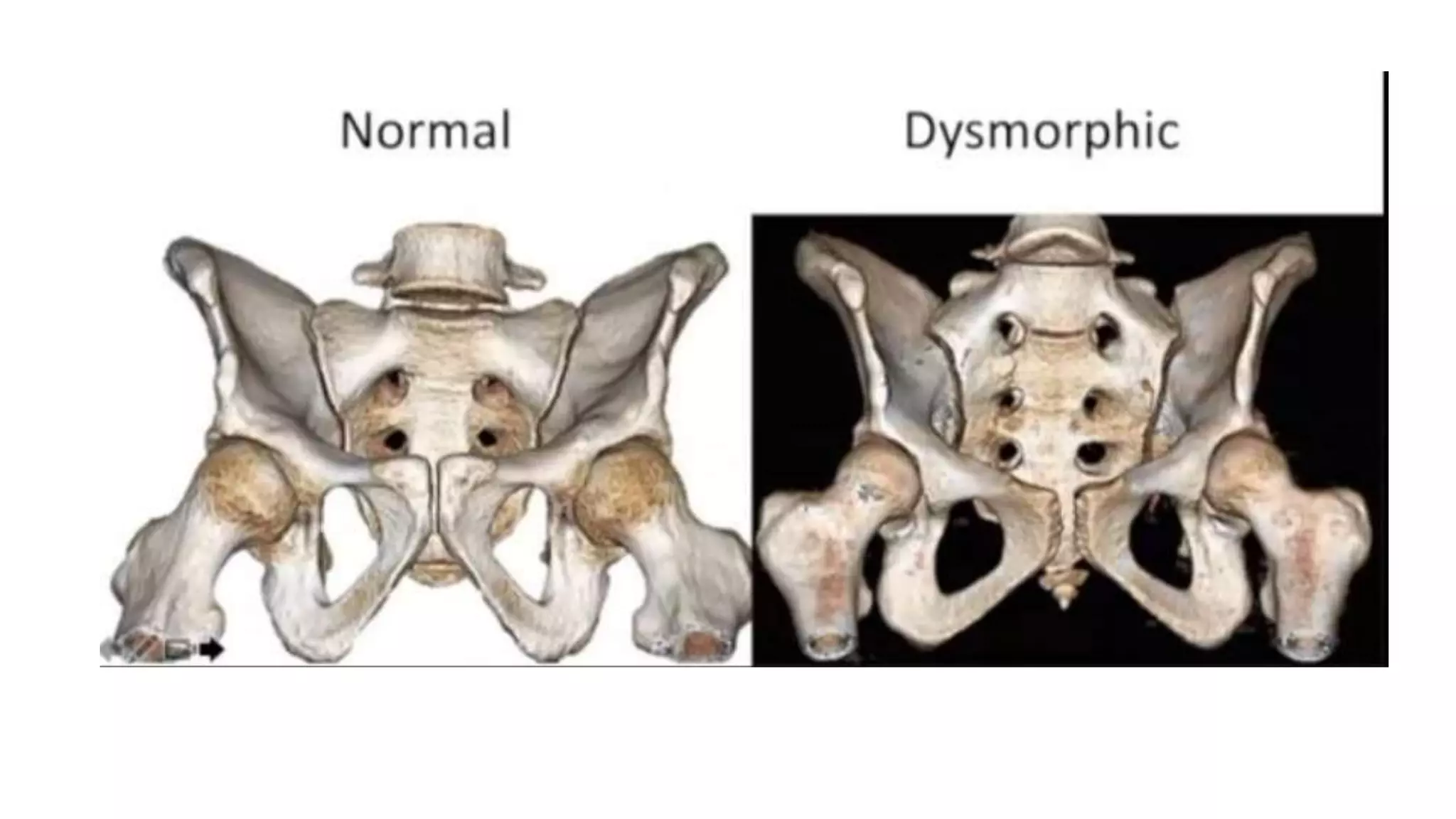 PELVIC RING FRACTURES | PPTX