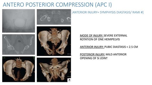 PELVIC RING FRACTURES | PPTX