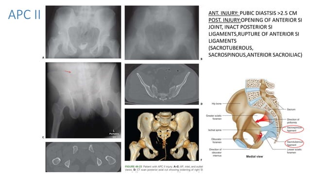 PELVIC RING FRACTURES | PPTX