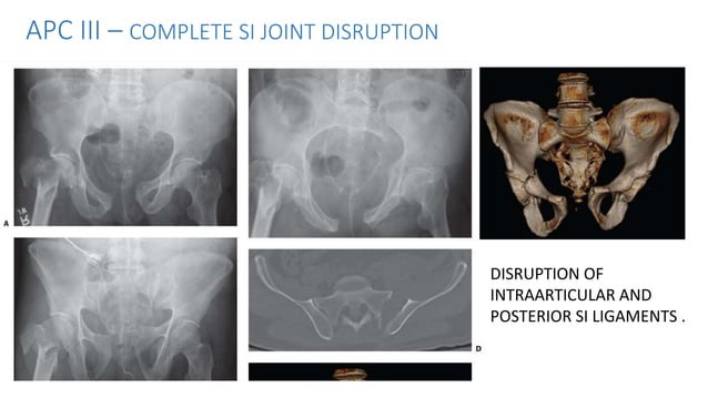 PELVIC RING FRACTURES | PPTX