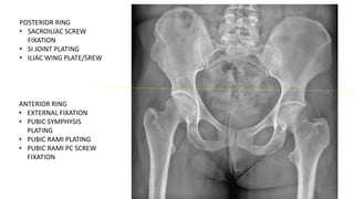 PELVIC RING FRACTURES | PPTX