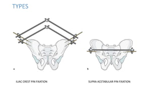 PELVIC RING FRACTURES | PPTX