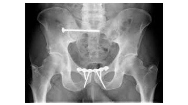 PELVIC RING FRACTURES | PPTX