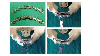 PELVIC RING FRACTURES | PPTX