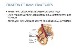PELVIC RING FRACTURES | PPTX