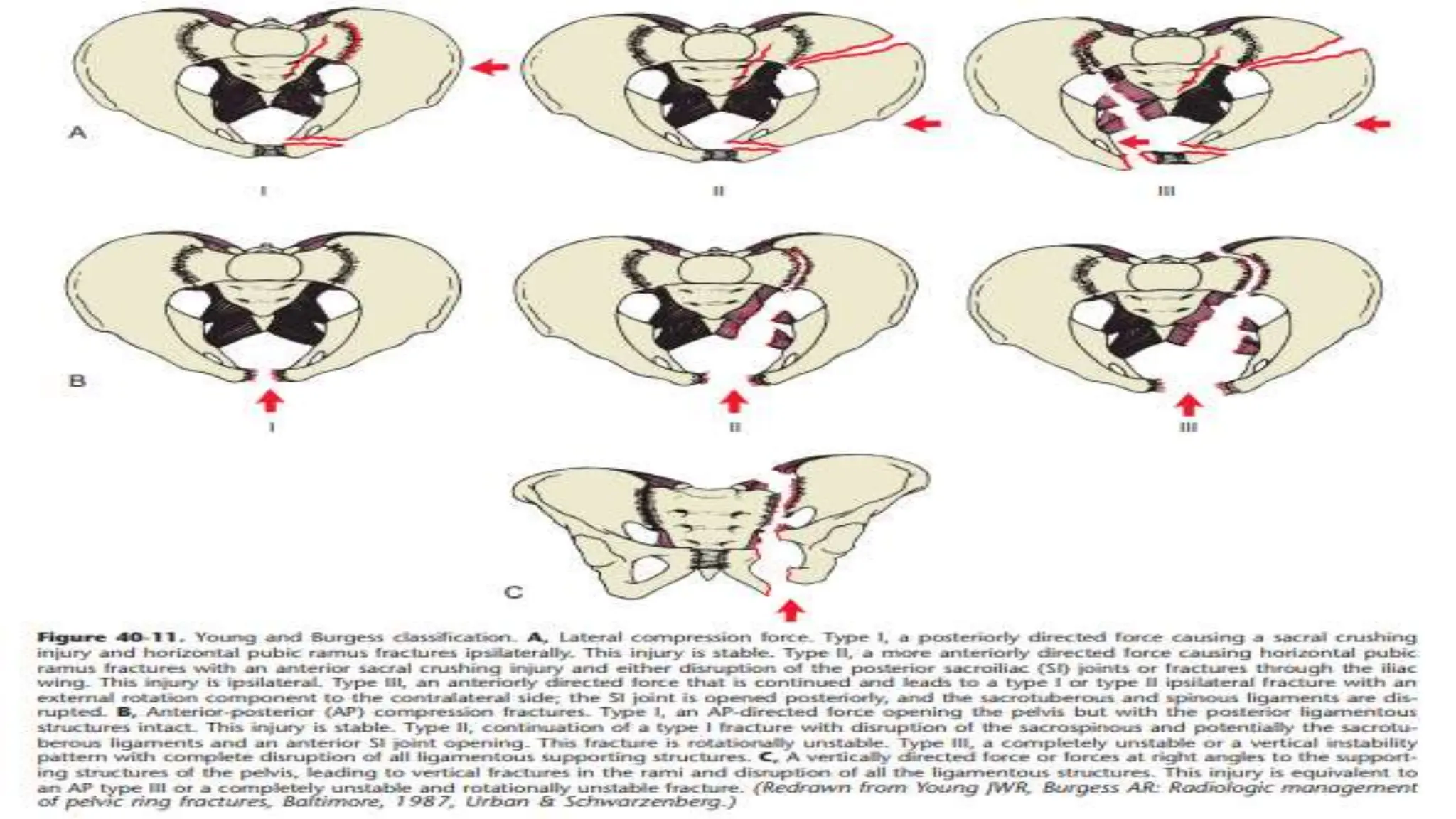 PELVIC RING FRACTURES AND CLASSIFICATIONS.pptx