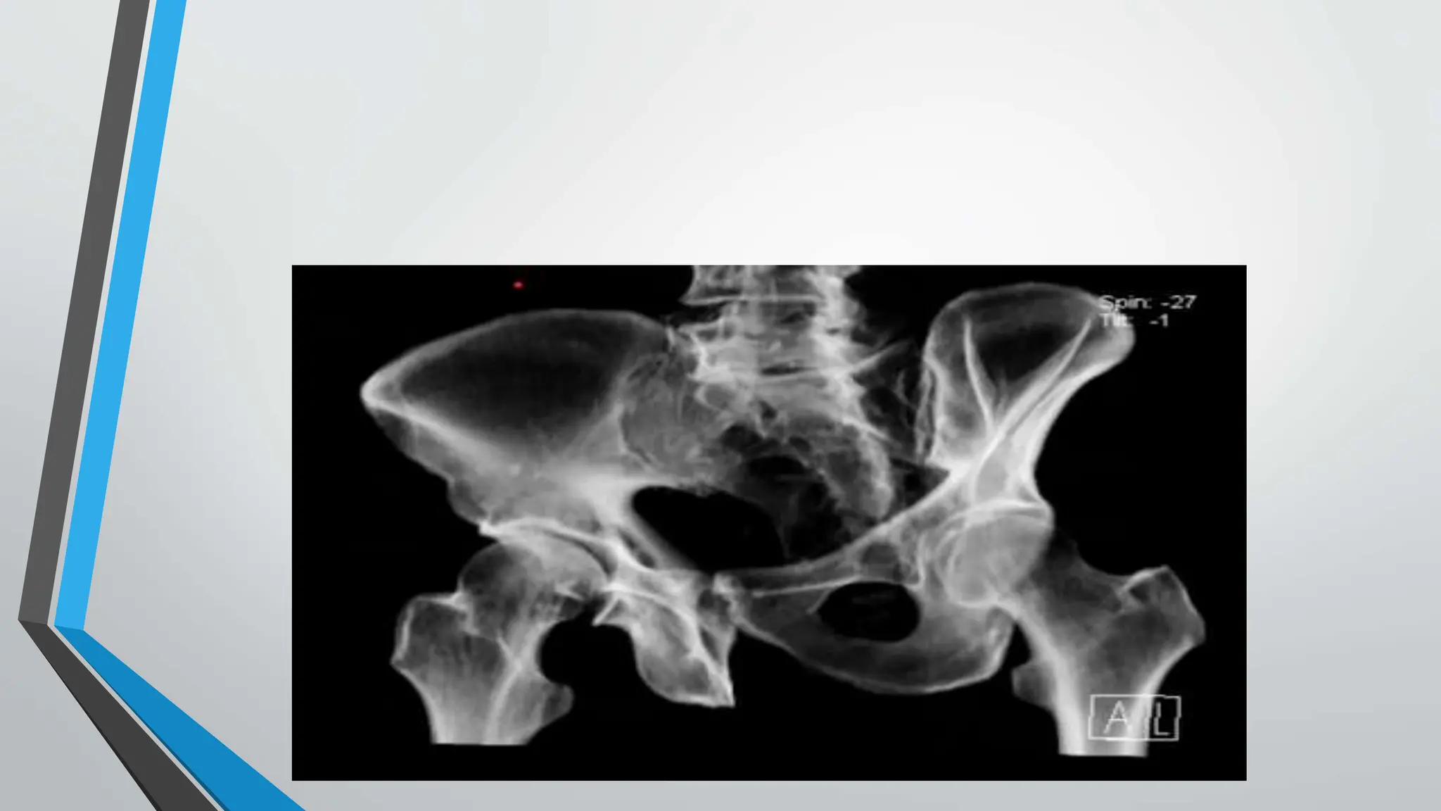PELVIC RING FRACTURES AND CLASSIFICATIONS.pptx