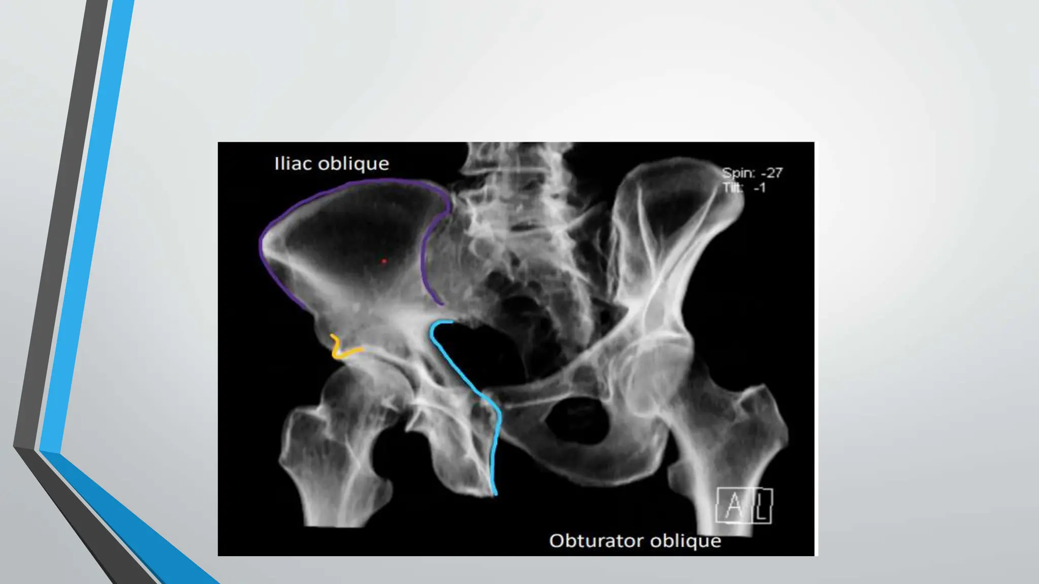 PELVIC RING FRACTURES AND CLASSIFICATIONS.pptx