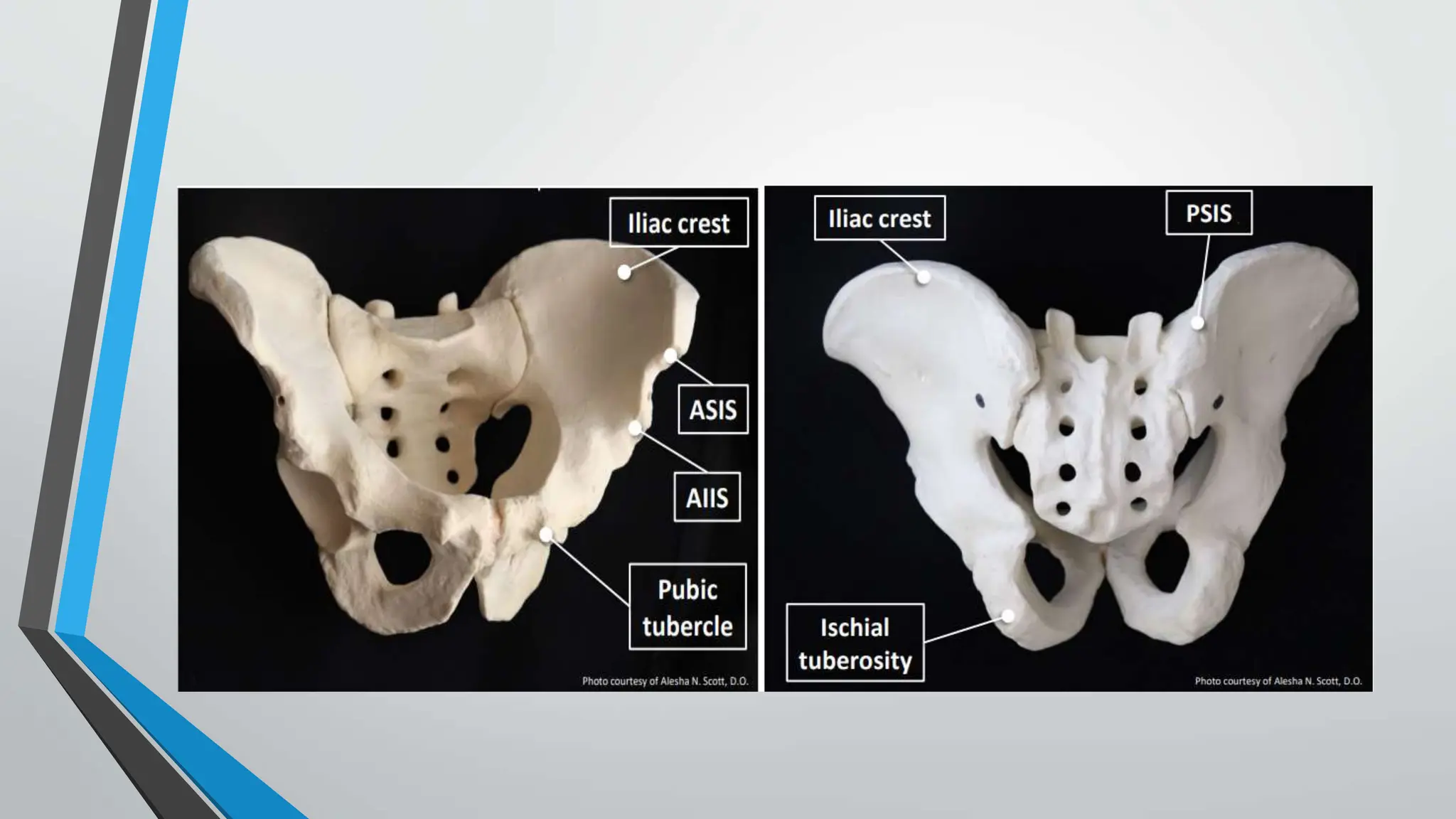 PELVIC RING FRACTURES AND CLASSIFICATIONS.pptx