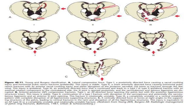 PELVIC RING FRACTURES AND CLASSIFICATIONS.pptx | Death, Injury, or ...