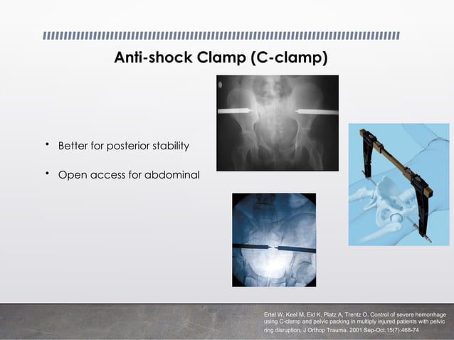 Pelvic Ring Injury diagnosis and management.pptx