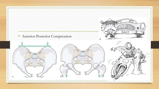 pelvic ring injury seminar 1.pptx