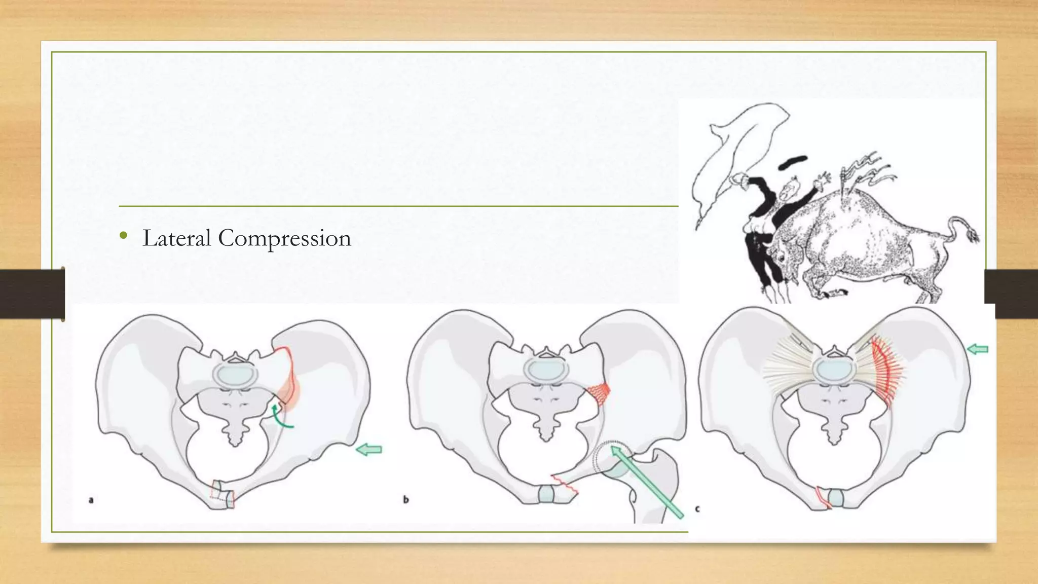PELVIC RING INJURY | PPTX