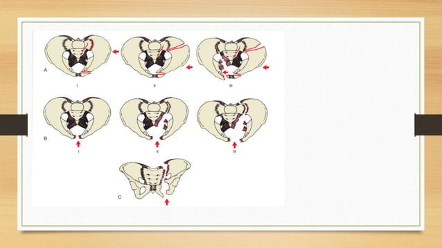 PELVIC RING INJURY | PPTX